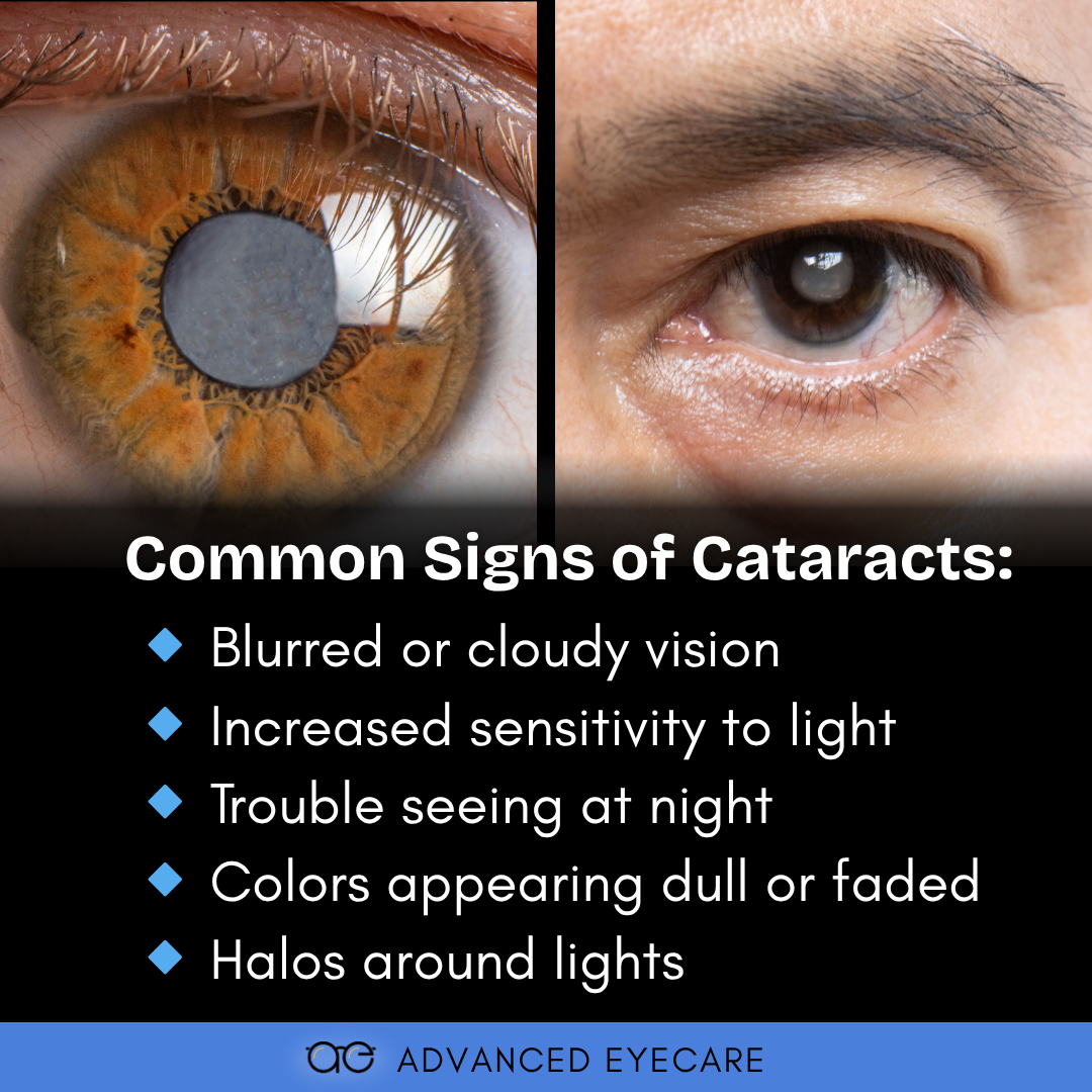Cataracts sign and Symptoms